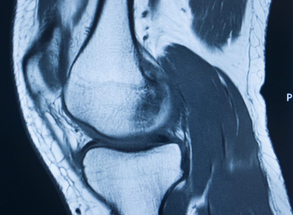 Mri Knee Mcl Tear